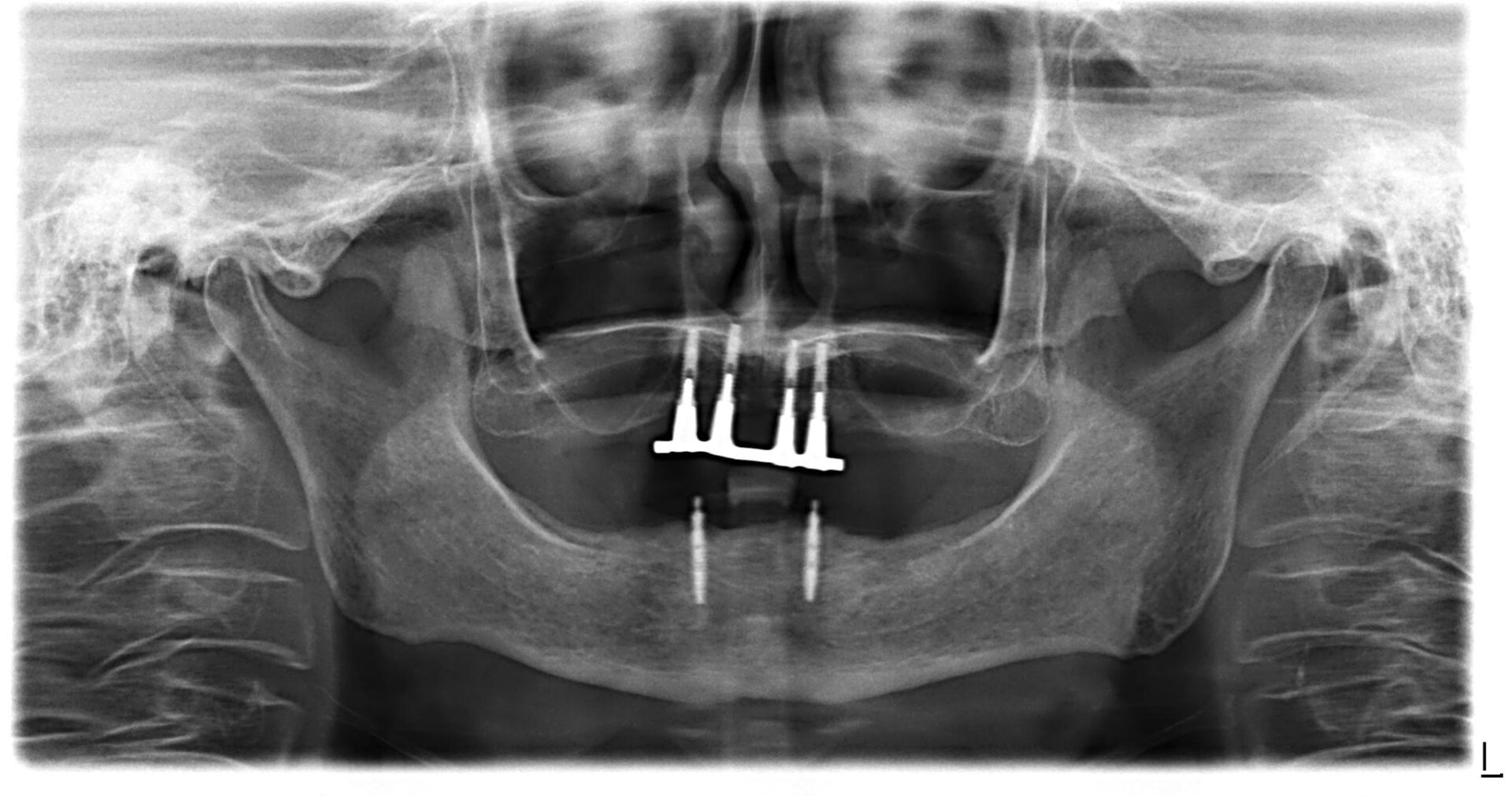 IOD（インプラント オーバー デンチュア） | 京都、大阪のインプラント・矯正は、一元会松井山手西川歯科医院